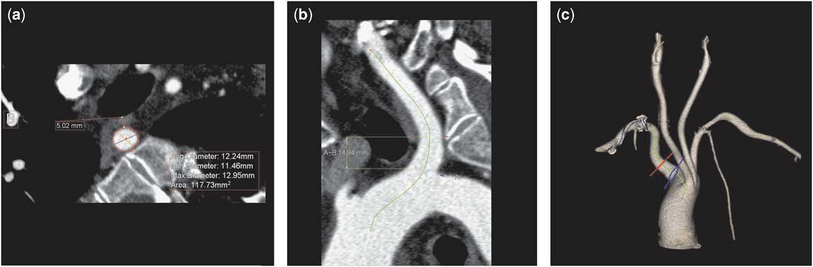 CT evaluation of aberrant right subclavian artery: anatomy and clinical ...