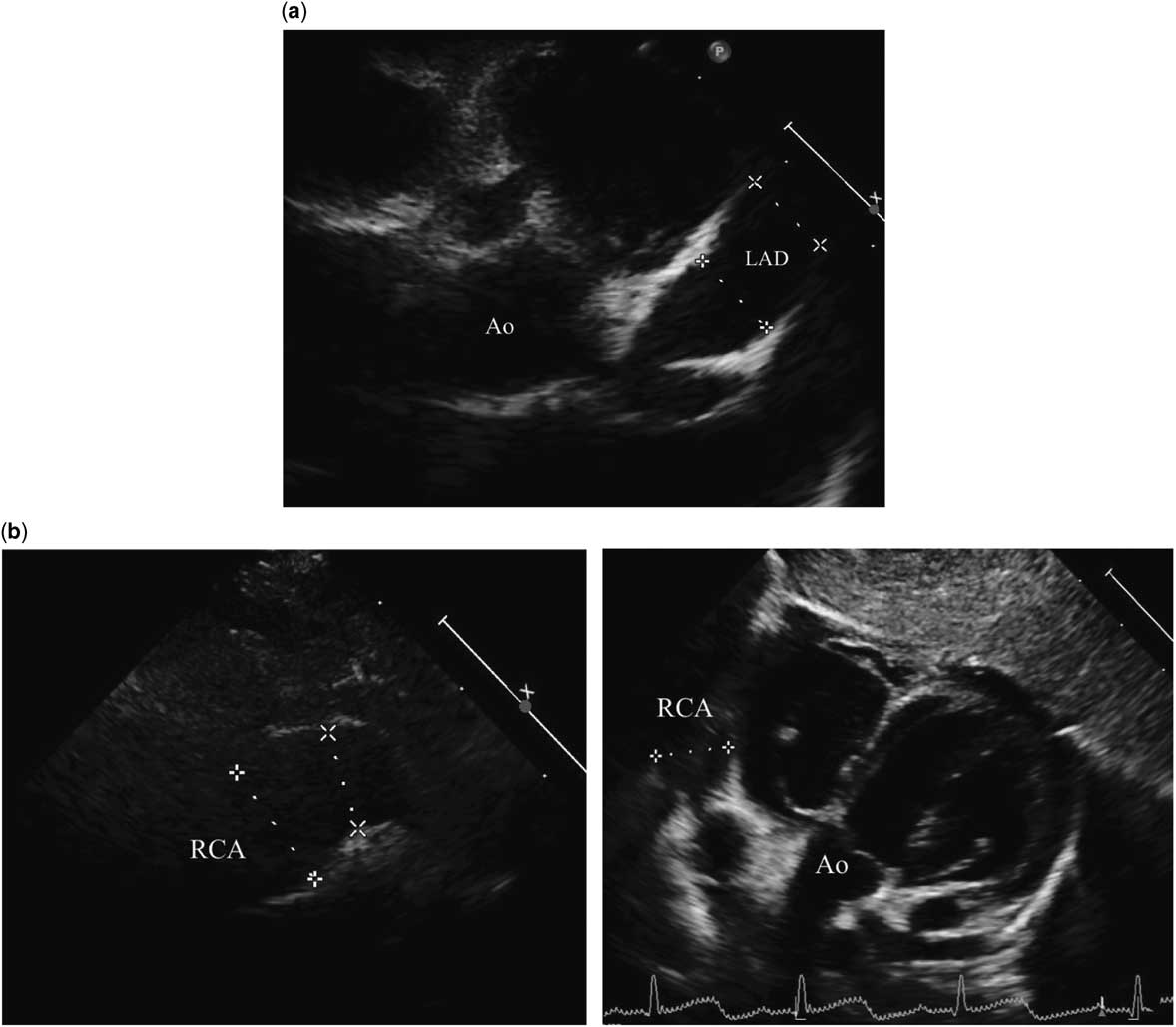 Transient Q-waves in an infant with asymptomatic myocardial infarction ...