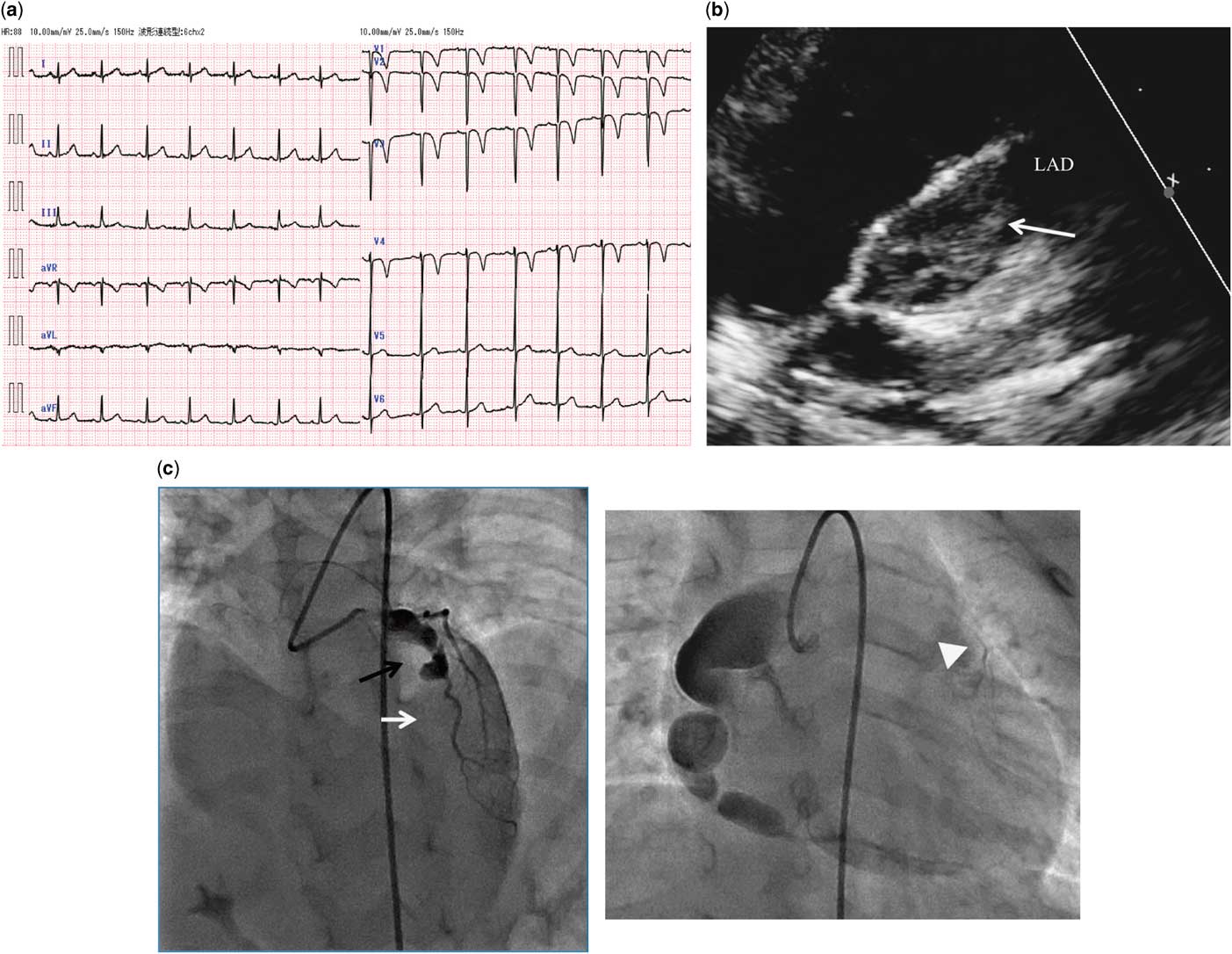 Transient Q-waves in an infant with asymptomatic myocardial infarction ...