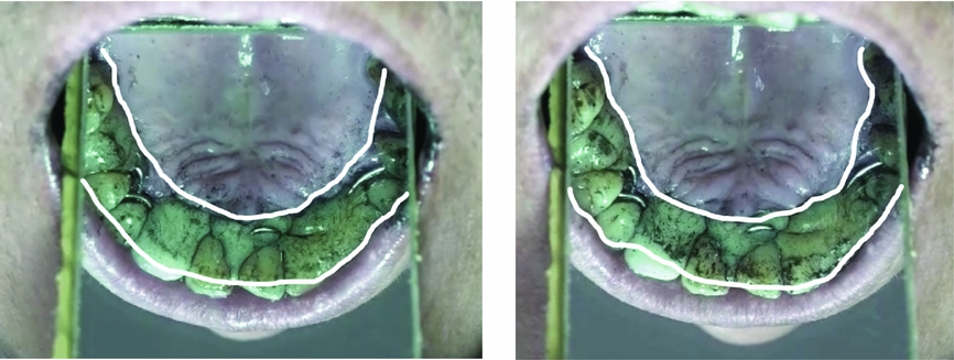 Voiceless nasal sounds in three Tibeto-Burman languages | Journal of ...