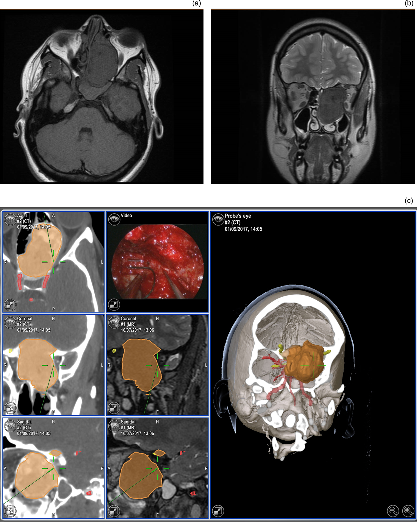 Endoscopic transnasal image-guided approach to diagnosis in orbital ...