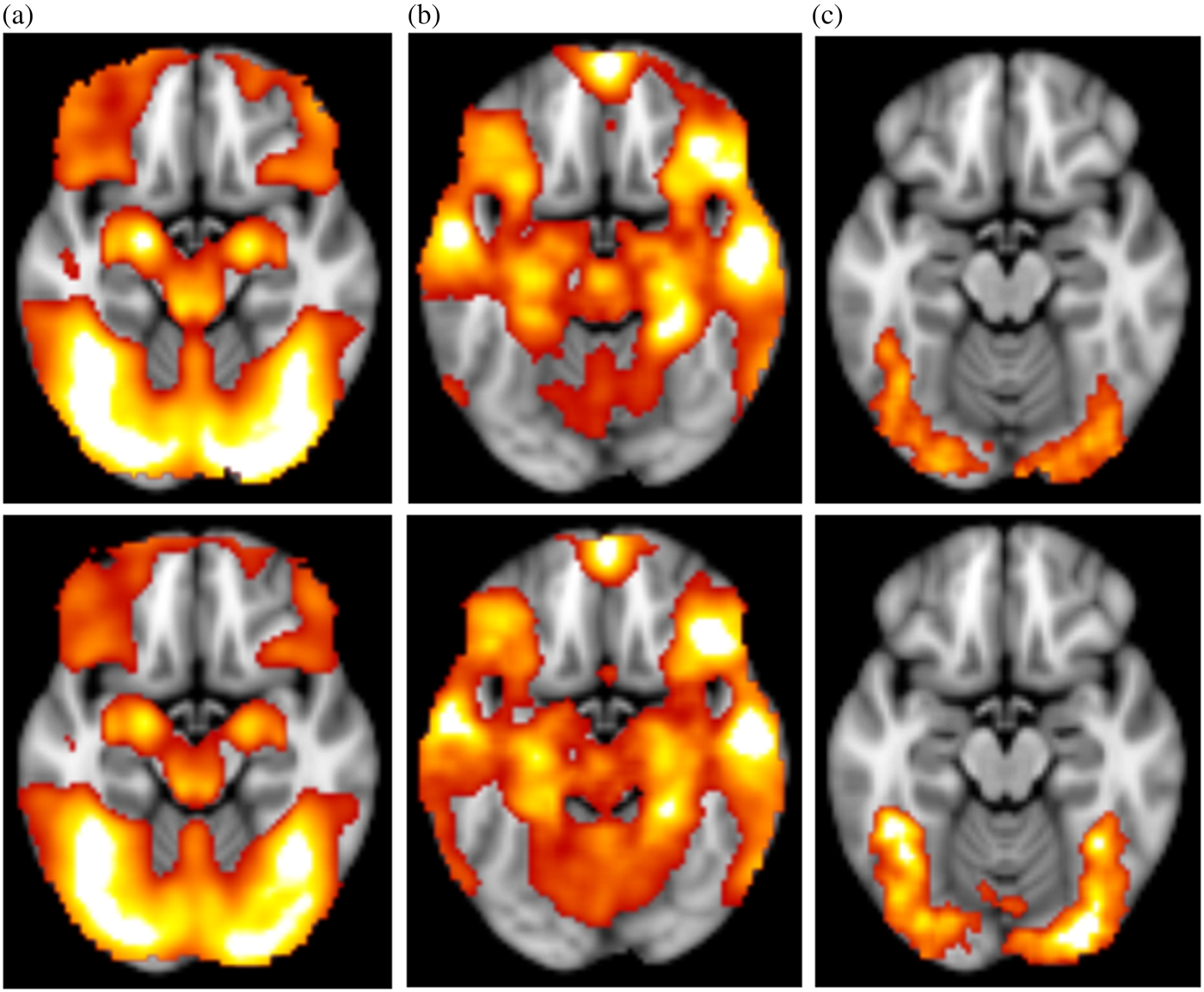 Trait neuroticism and emotion neurocircuitry: Functional magnetic ...