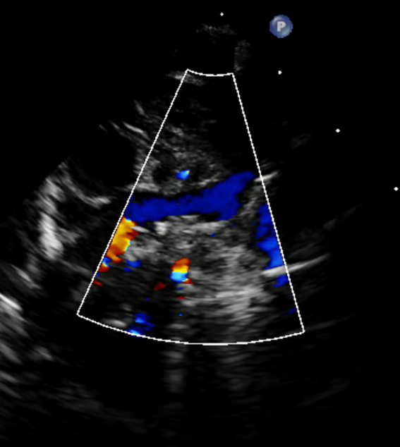 Isolated retroaortic innominate vein and right aortic arch: a case ...