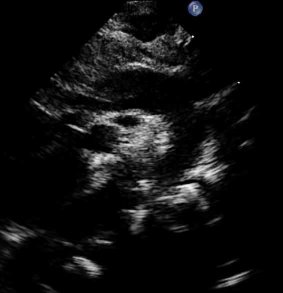 Isolated retroaortic innominate vein and right aortic arch: a case ...