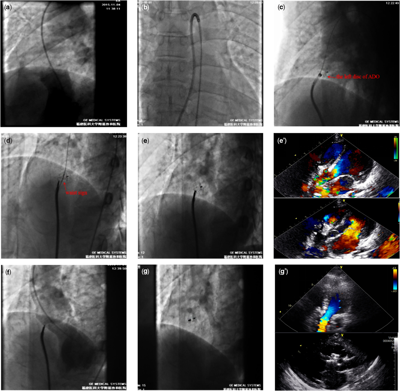 Transcatheter closure of doubly committed subarterial ventricular ...