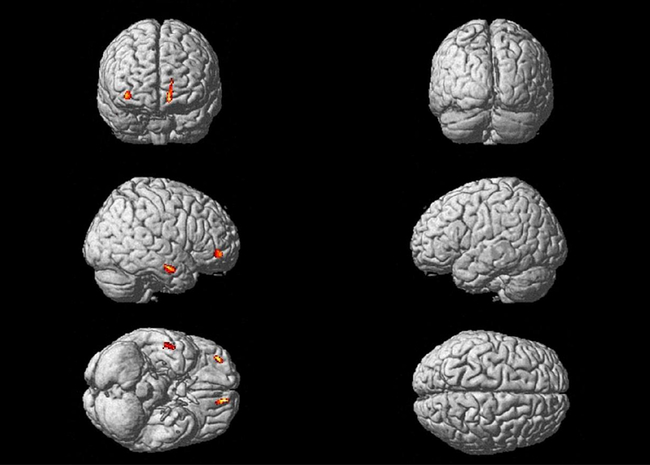 Reduced grey matter volume in frontal and temporal areas in depression: contributions from voxel ...