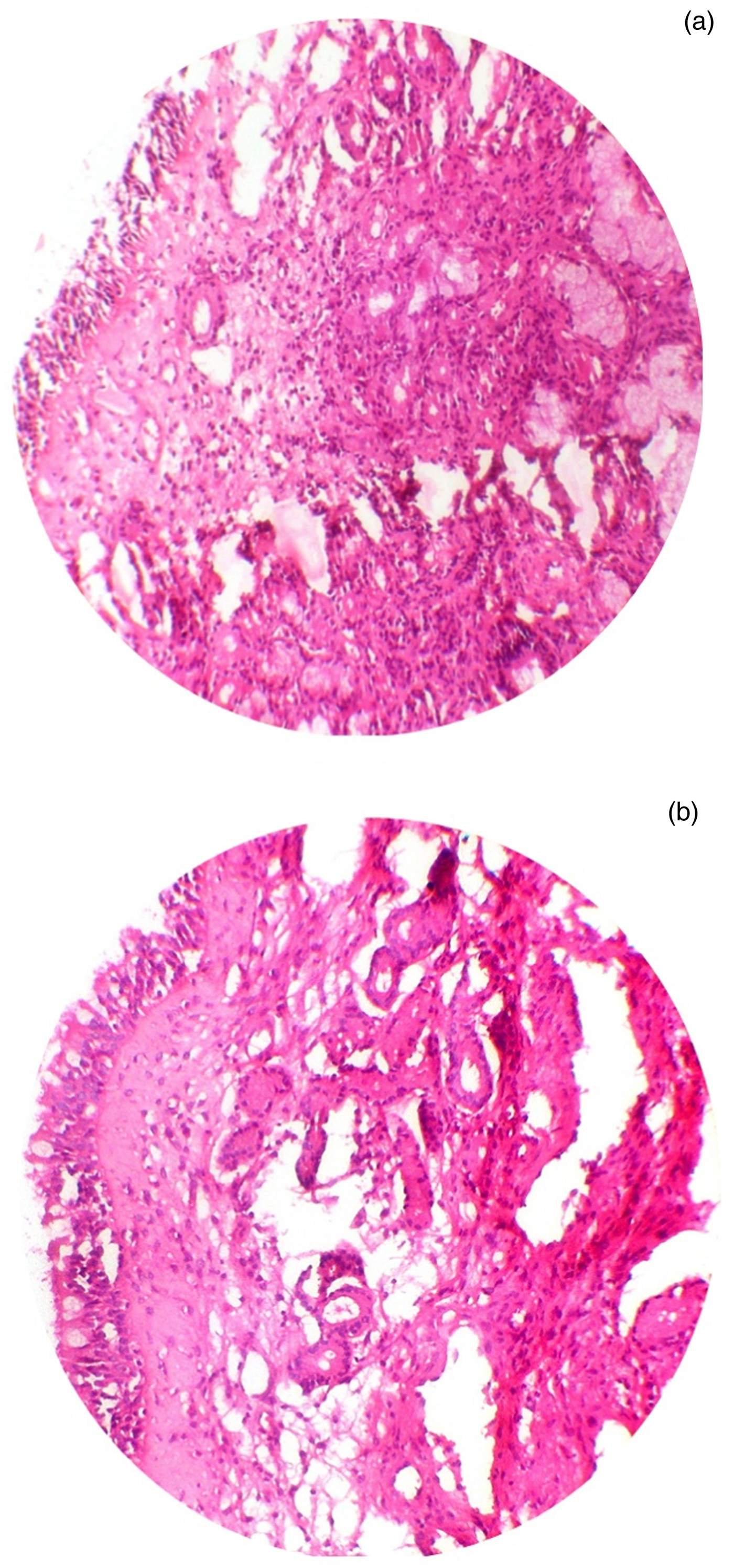 Endoscopic posterior nasal neurectomy | The Journal of Laryngology ...
