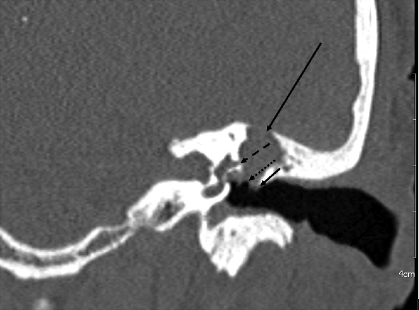 Radiology of acute mastoiditis and its complications: a pictorial ...