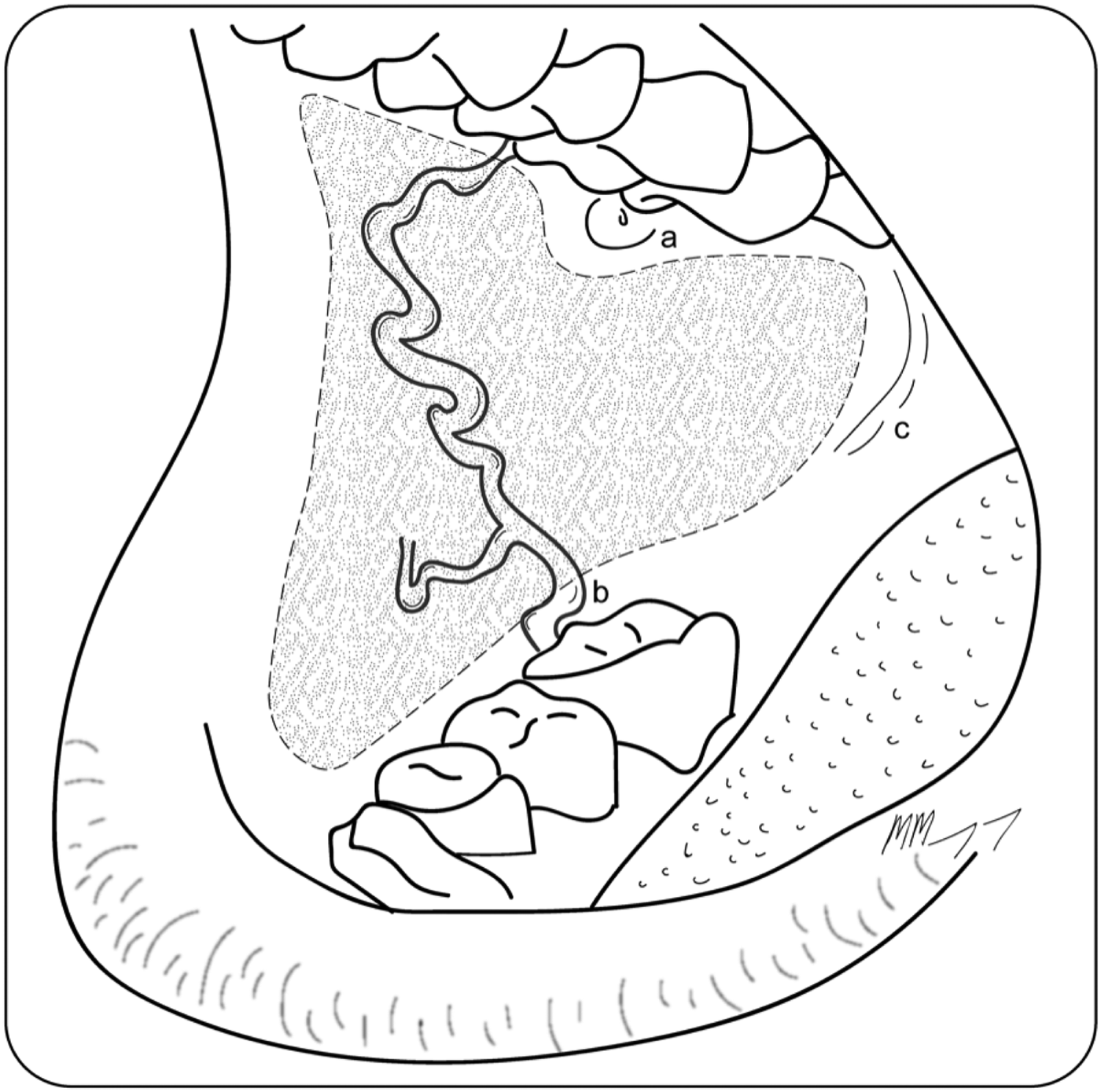 Facial artery musculomucosal flaps in oropharyngeal reconstruction ...