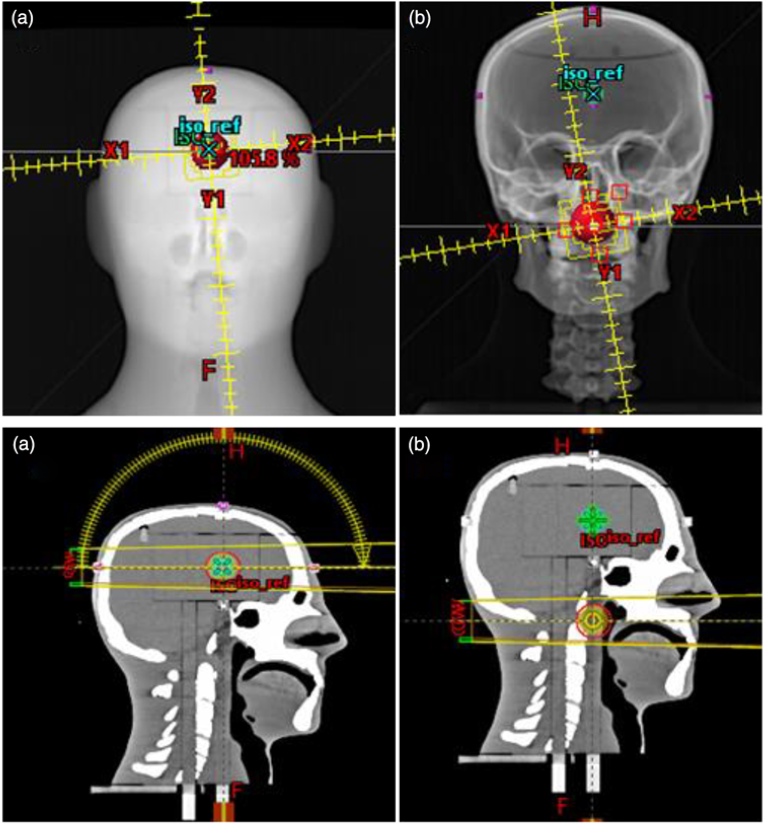 Evaluating small field dosimetry with the Acuros XB (AXB) and ...