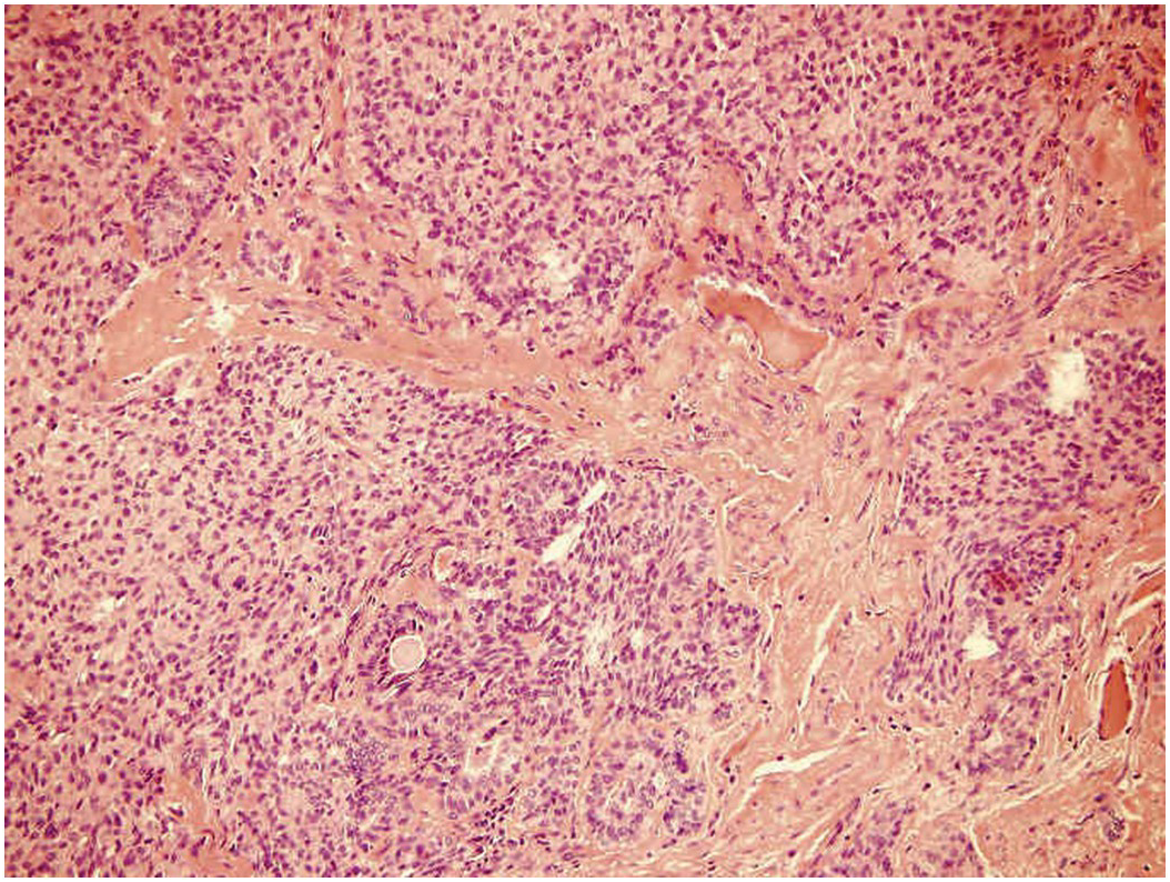 Pleomorphic Adenoma Cytology Libre Pathology