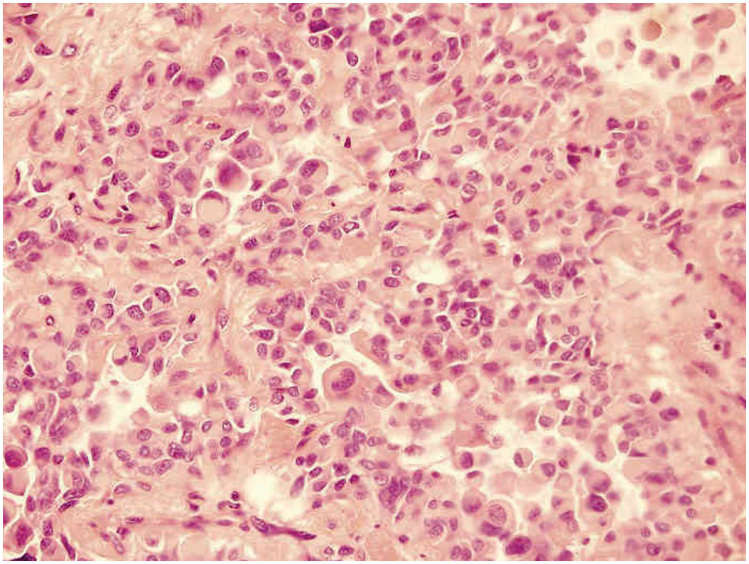 Pleomorphic Adenoma Cytology Libre Pathology