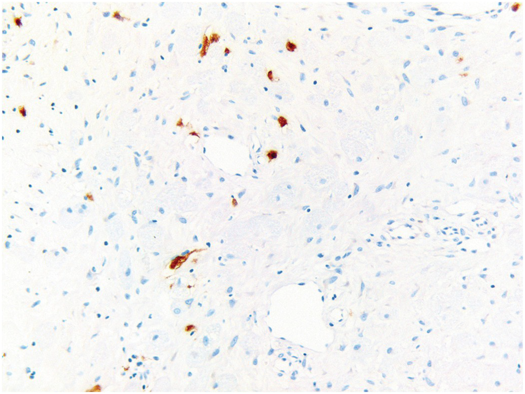 Congenital Epulis Of Newborn Pathology Outlines