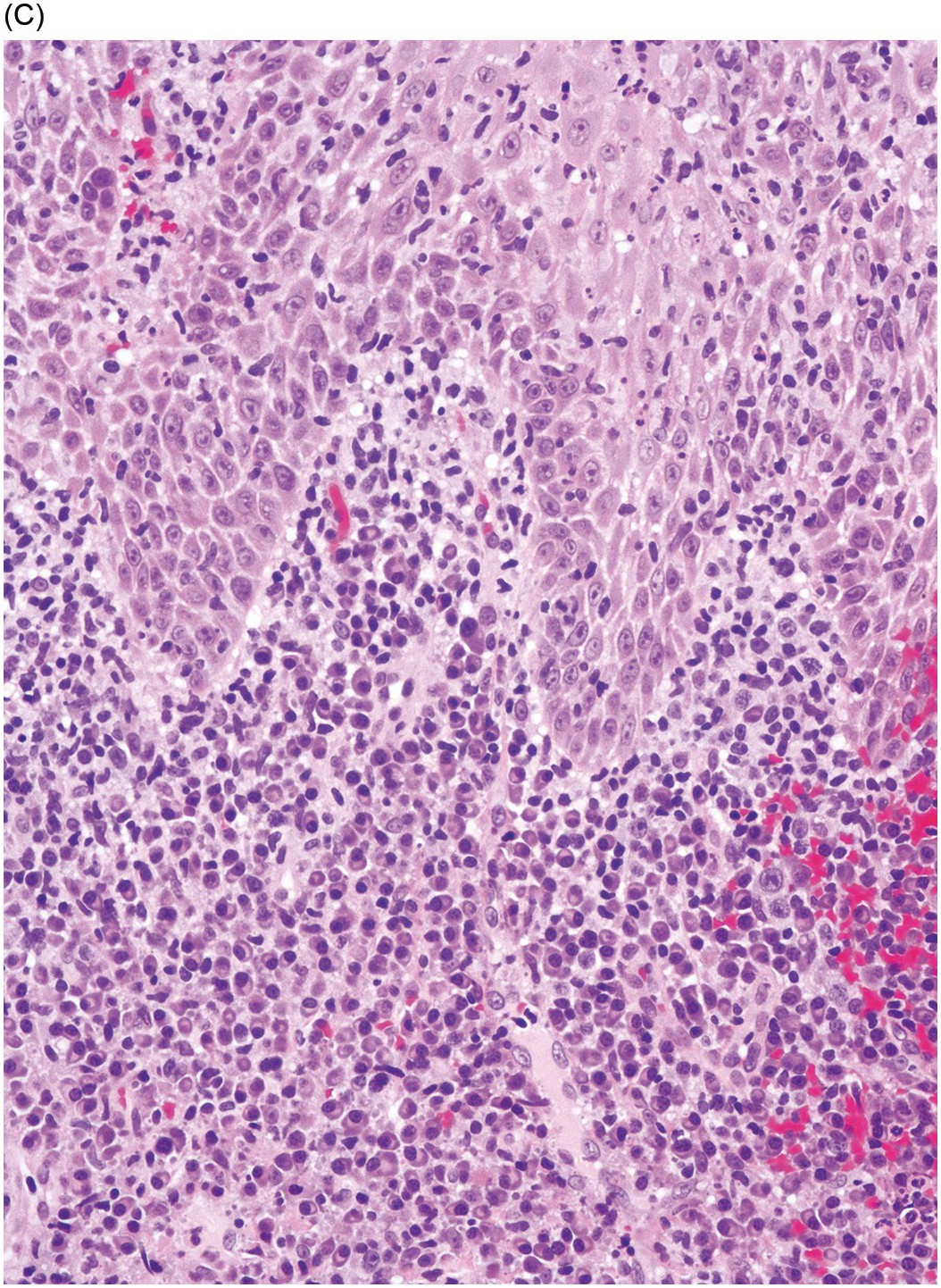 Neurosyphilis Histology