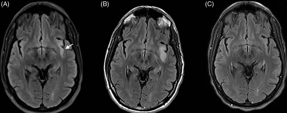 Anti-LGI1 Limbic Encephalitis Presenting as an Expanding Insular Lesion | Canadian Journal of ...