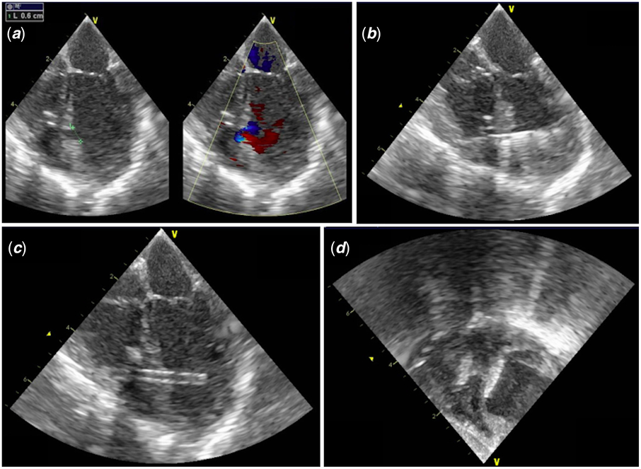 Arterial switch procedure and hybrid muscular ventricular septal defect ...