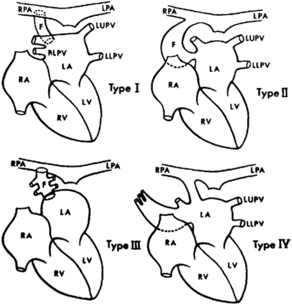 Transcatheter closure of right pulmonary artery to left atrium fistula ...