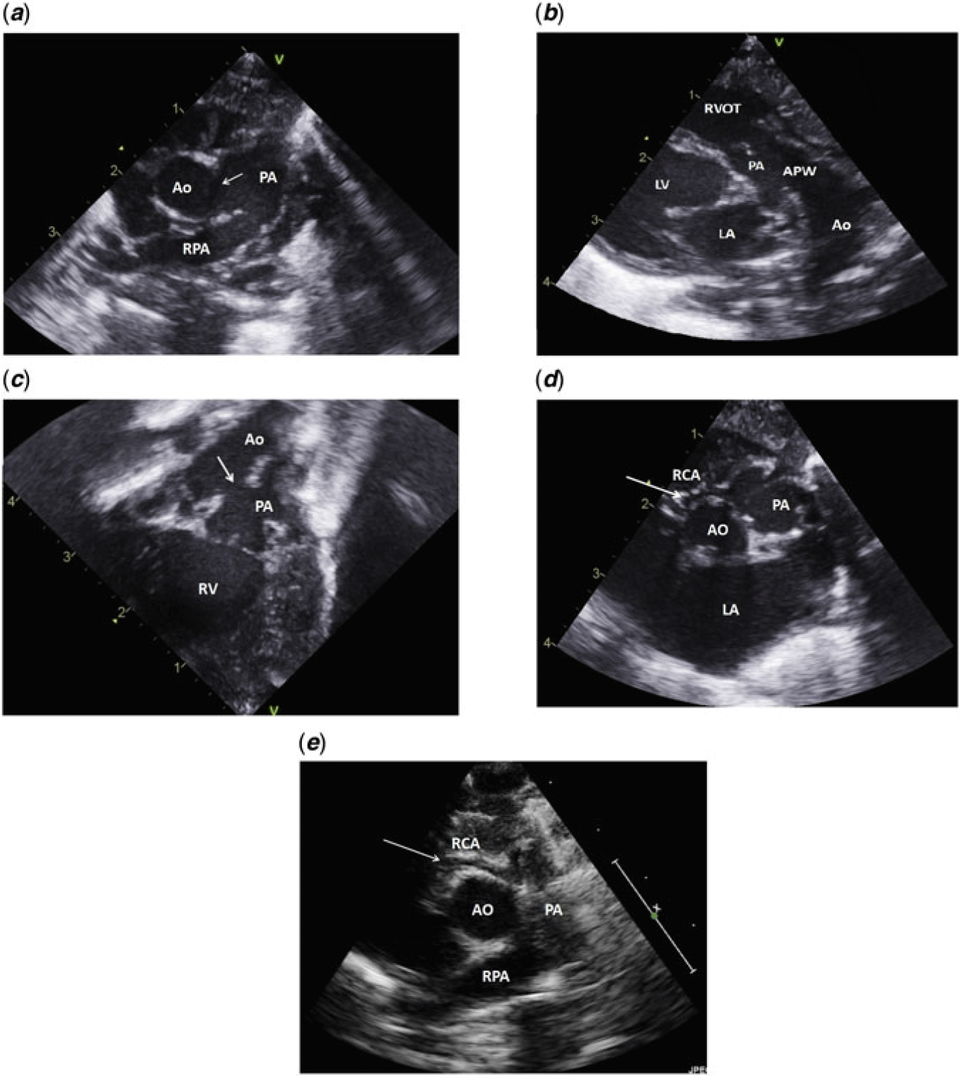 Aortopulmonary window with anomalous right coronary artery from the ...