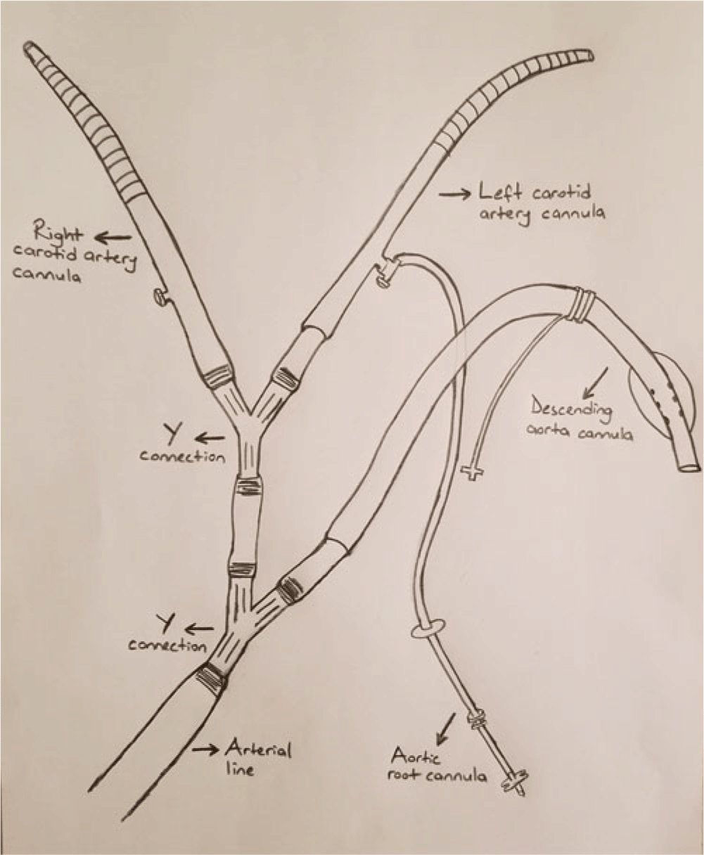 A surgical technique for ascending aorta, aortic arch and descending ...