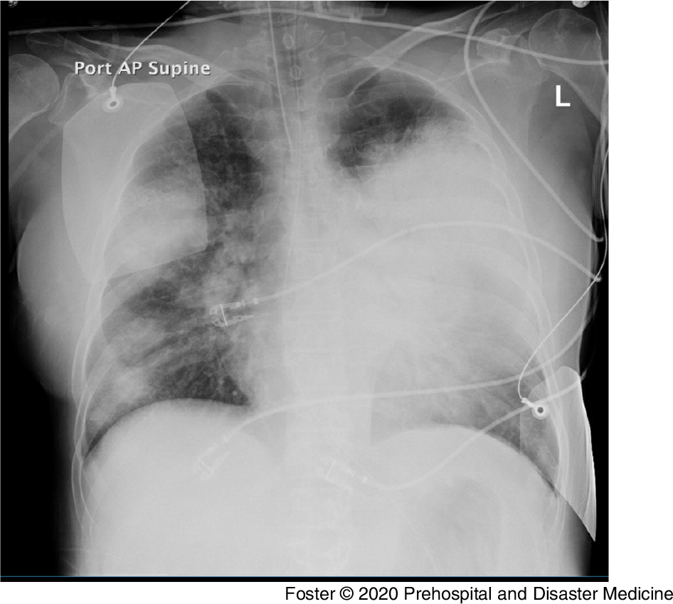 Inhaled Epoprostenol to Facilitate Safe Transport in Legionnaires ...