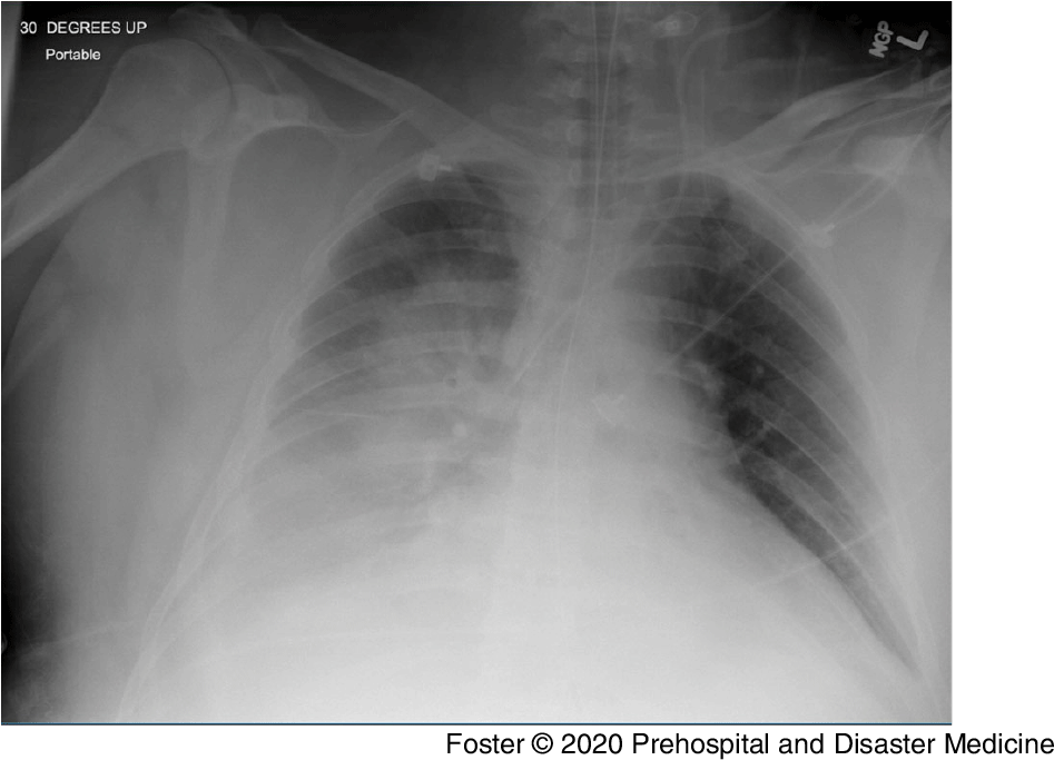 Inhaled Epoprostenol to Facilitate Safe Transport in Legionnaires ...
