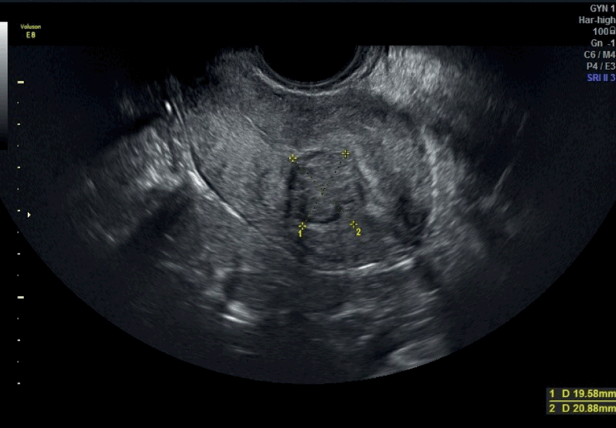 Intramural Fibroid Ultrasound
