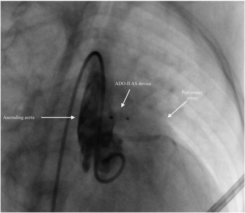 Transcatheter closure of aortopulmonary window with Amplatzer duct ...