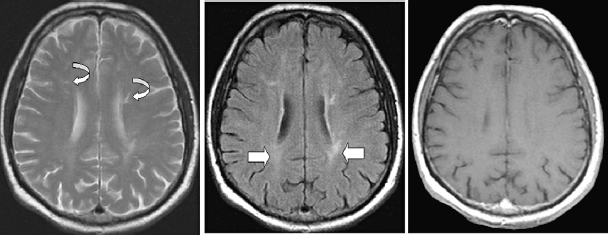 Psychiatric symptoms and cognitive dysfunction caused by Epstein–Barr ...
