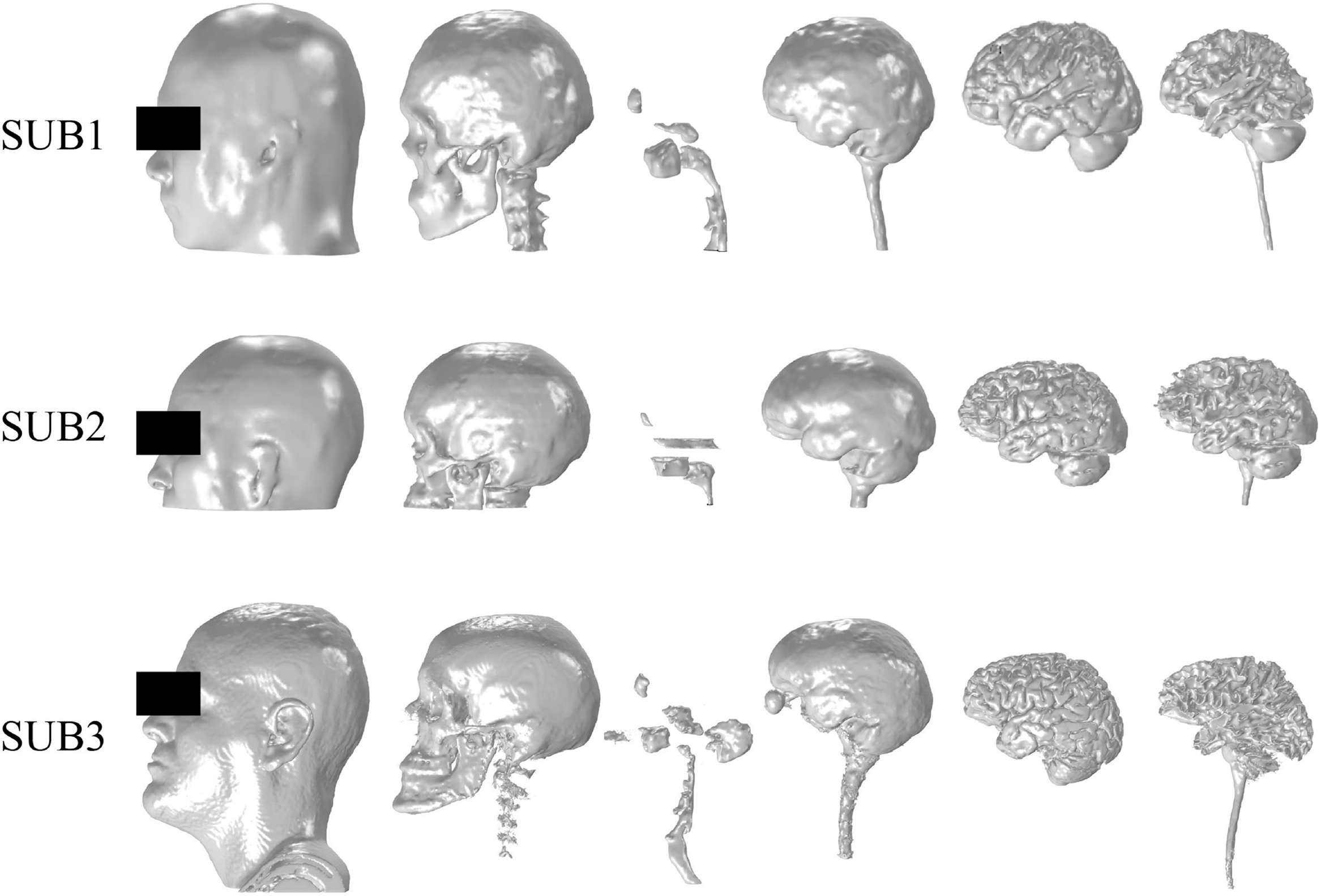 Computational models of Bitemporal, Bifrontal and Right Unilateral ECT ...