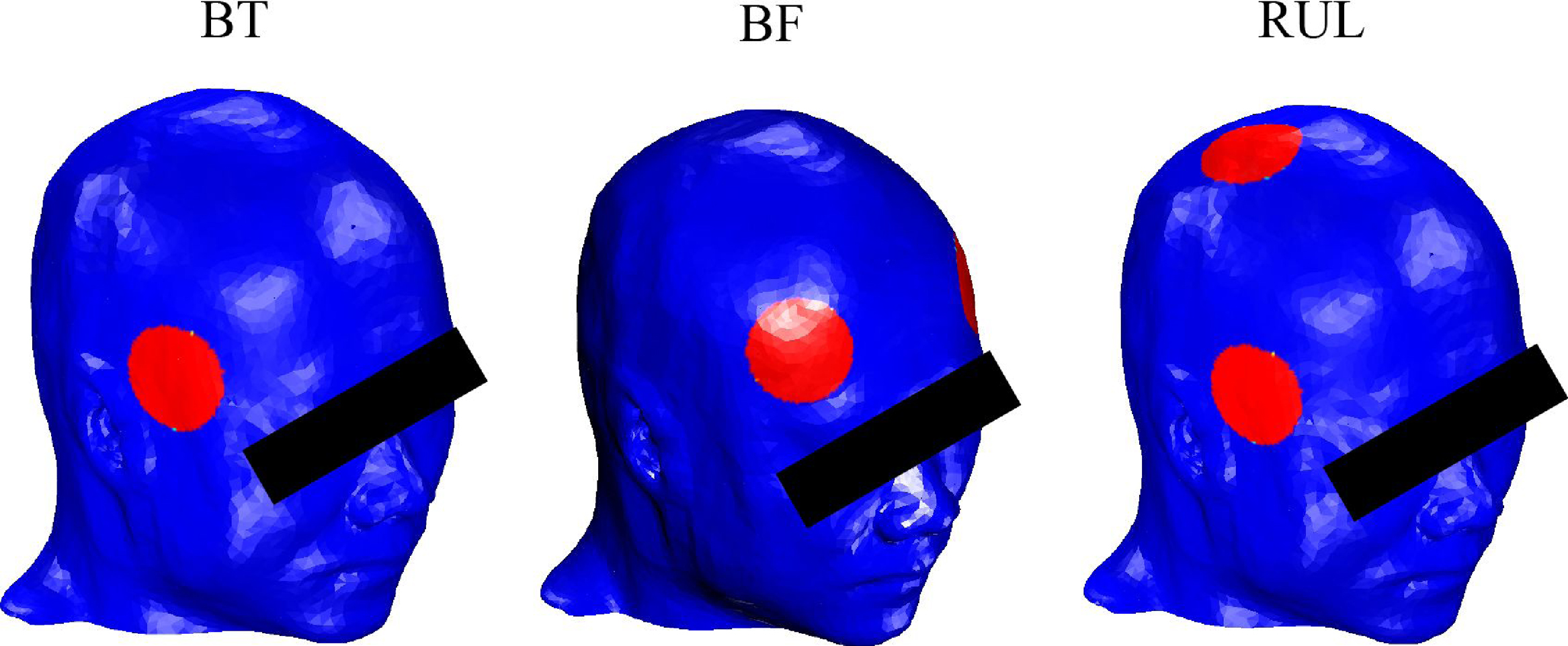 Computational models of Bitemporal, Bifrontal and Right Unilateral ECT ...