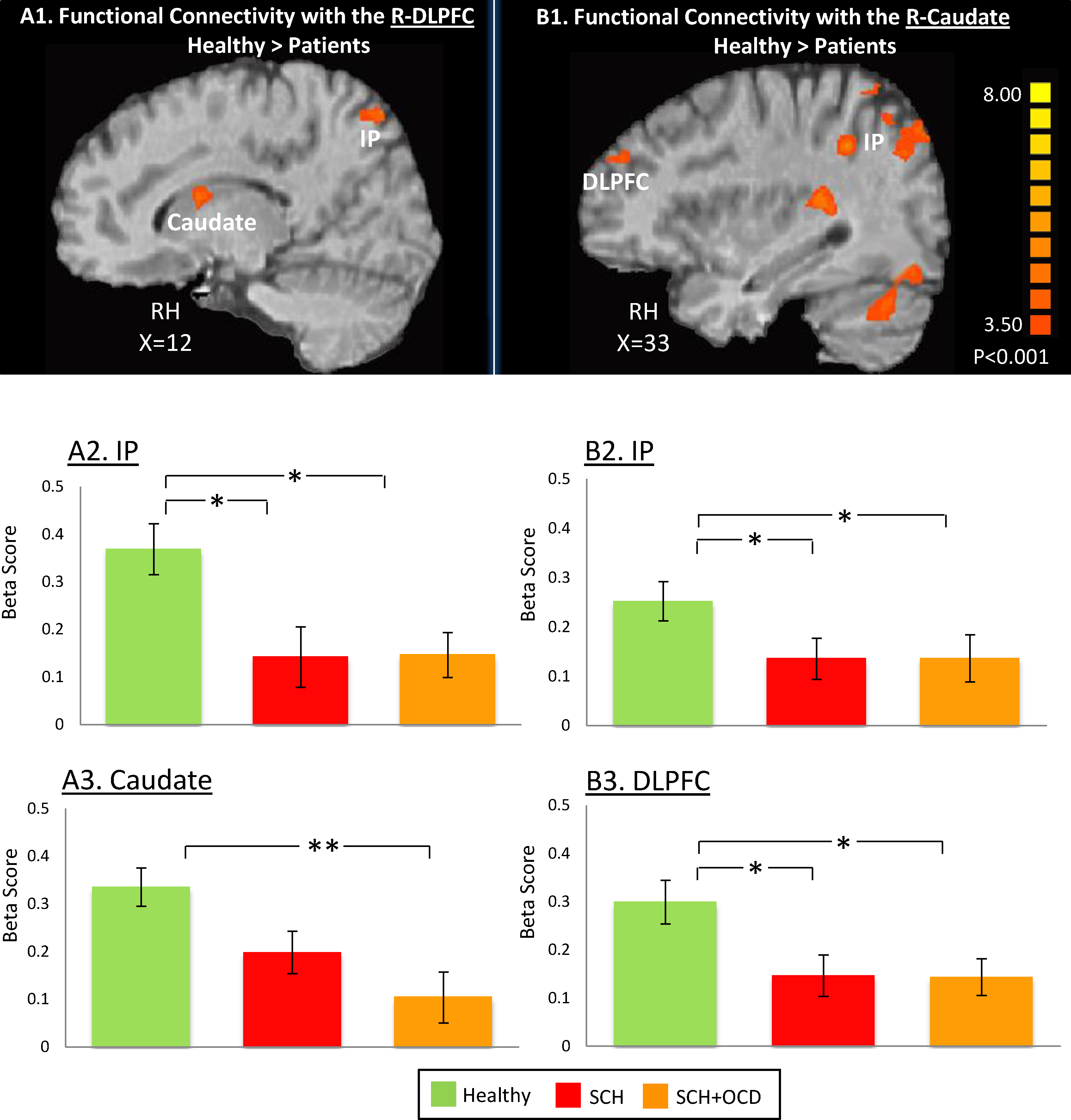 Working memory dysfunction in schizophrenia patients with obsessive ...