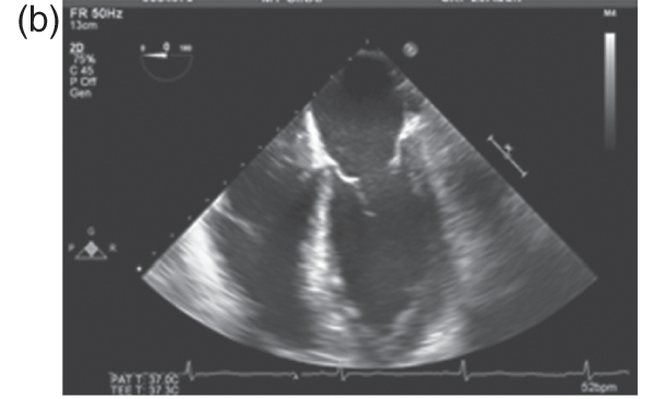 Transesophageal Echocardiogram 4 Chamber