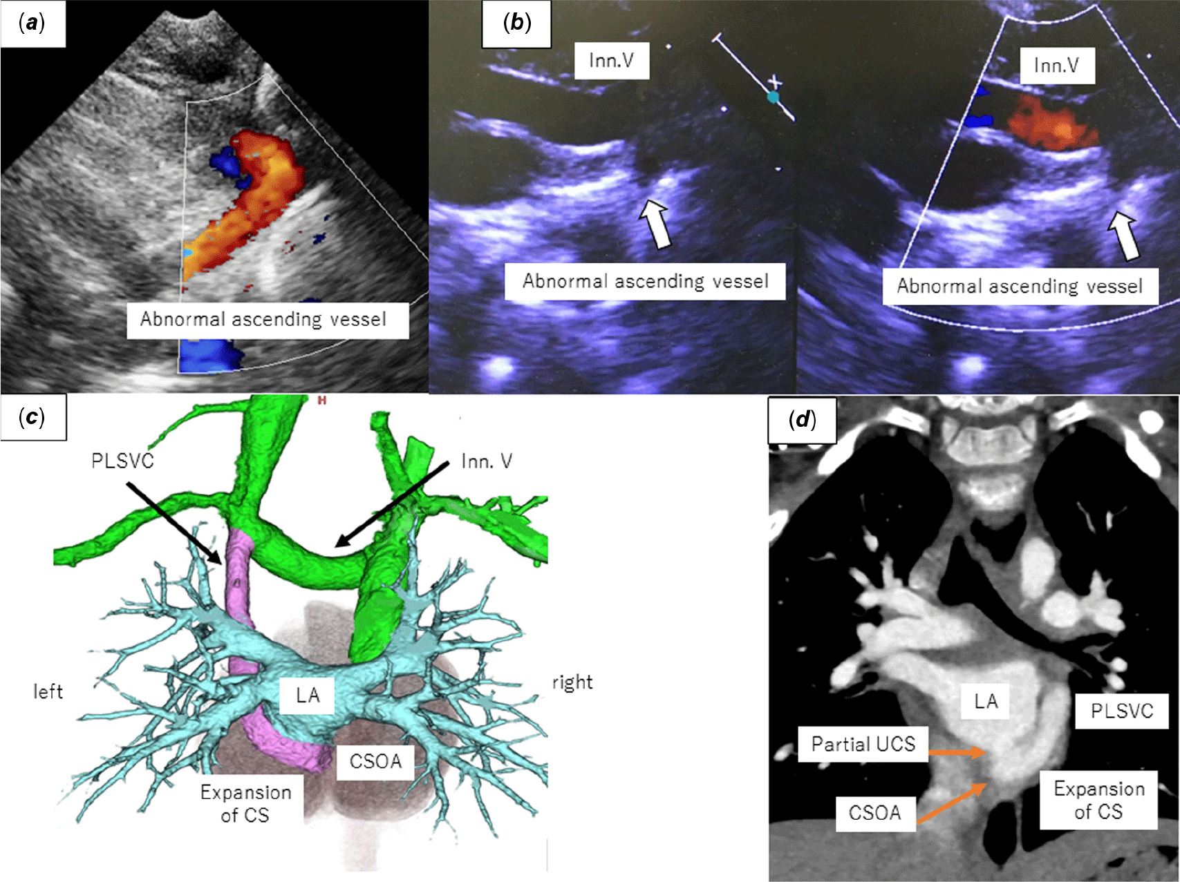 Bidirectional coronary venous return in the partial unroofed coronary ...