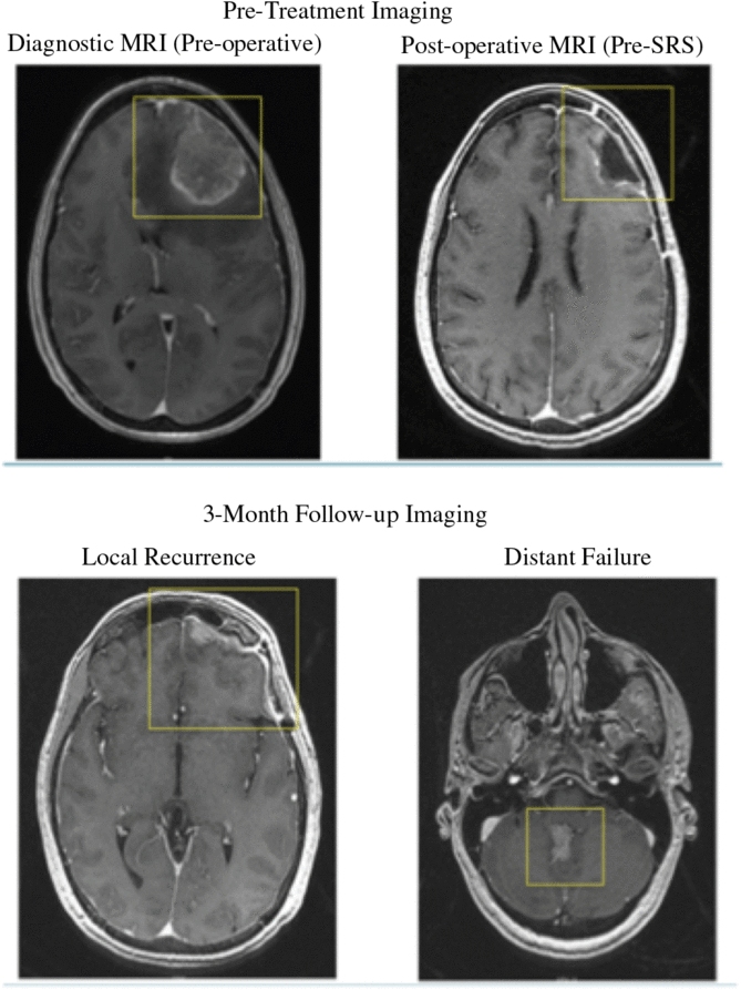 Post-operative stereotactic radiosurgery of brain metastases: A single ...