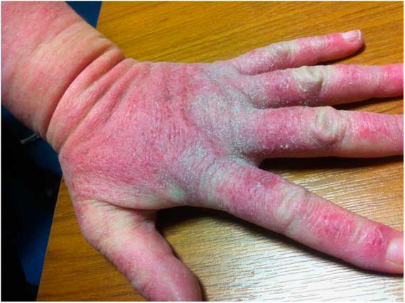 A clozapine-induced hypersensitivity reaction | Irish Journal of ...