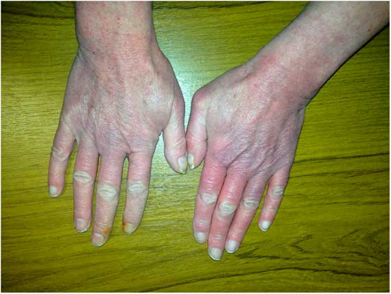A clozapine-induced hypersensitivity reaction | Irish Journal of ...