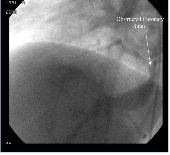 Coronary sinus stenosis: an underdiagnosed cause for paediatric ...
