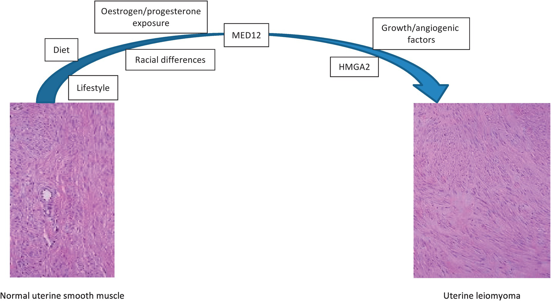 Pathophysiology of Uterine Fibroids (Chapter 1) - Modern Management of ...