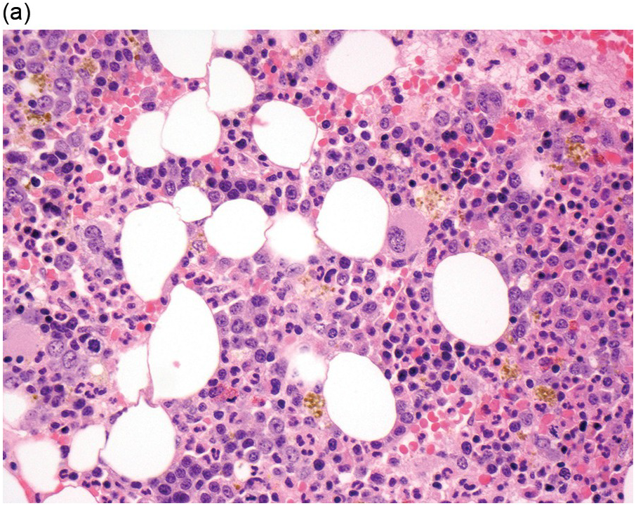 Myelodysplastic Syndrome Bone Marrow