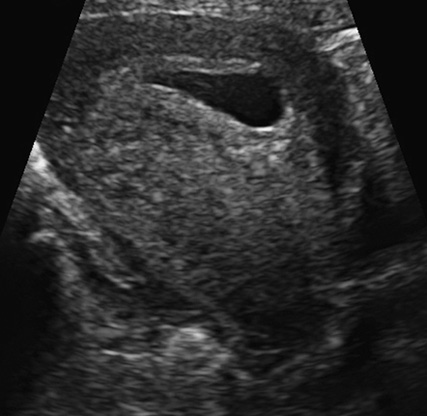 Introduction to Early Pregnancy Ultrasound (Chapter 1) - Early ...