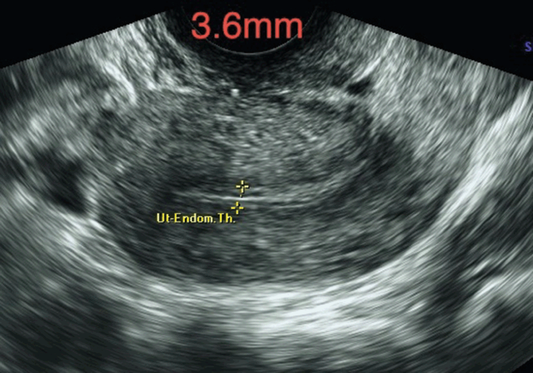Introduction (Chapter 1) - Ultrasound in Assisted Reproduction and ...