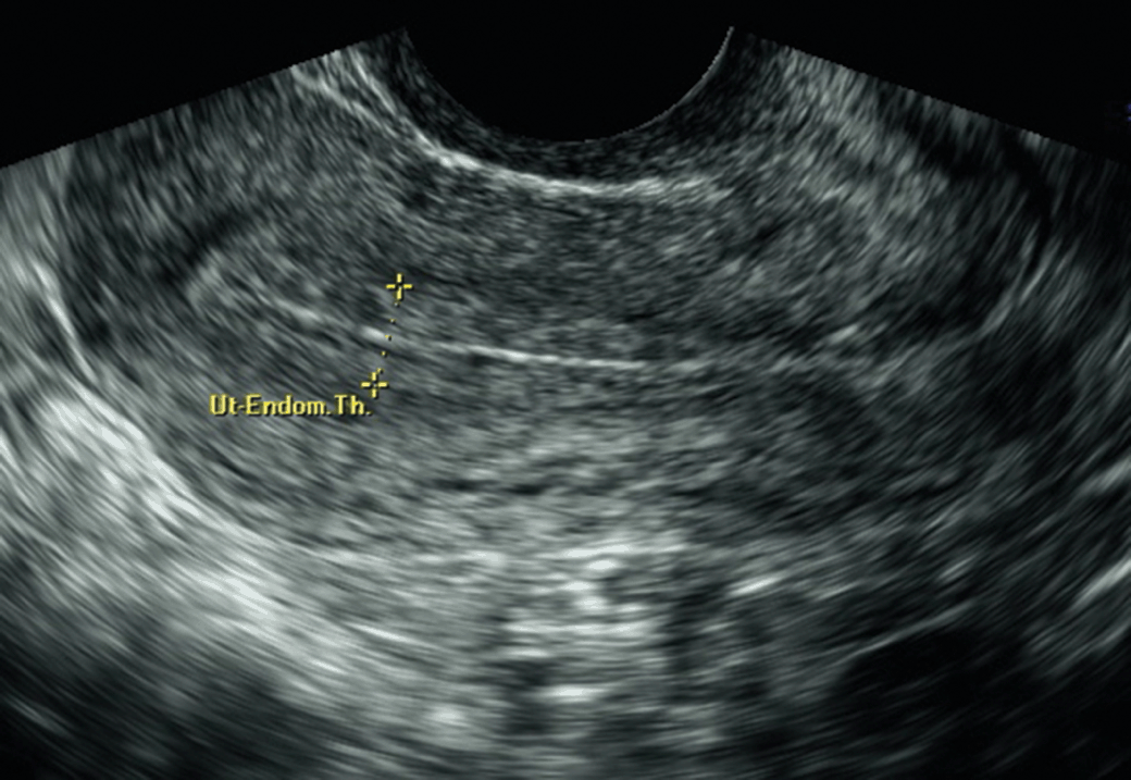 Introduction (Chapter 1) - Ultrasound in Assisted Reproduction and ...