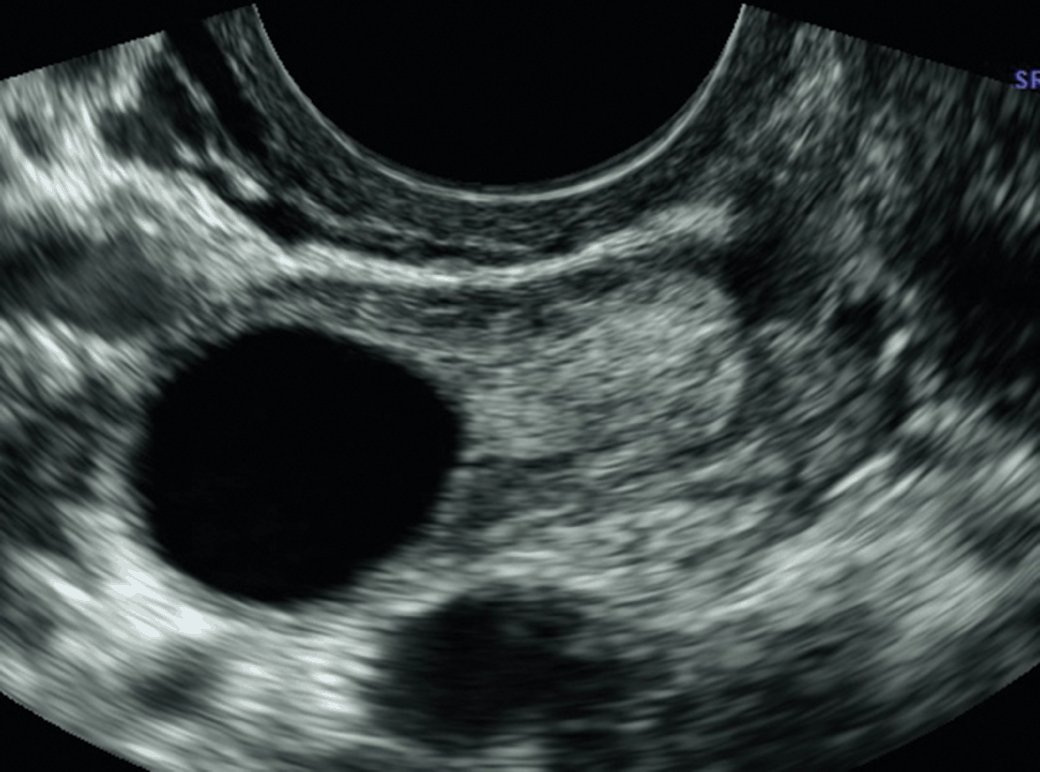 Introduction (Chapter 1) - Ultrasound in Assisted Reproduction and ...
