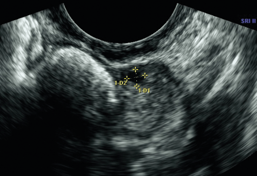 Introduction (Chapter 1) - Ultrasound in Assisted Reproduction and ...