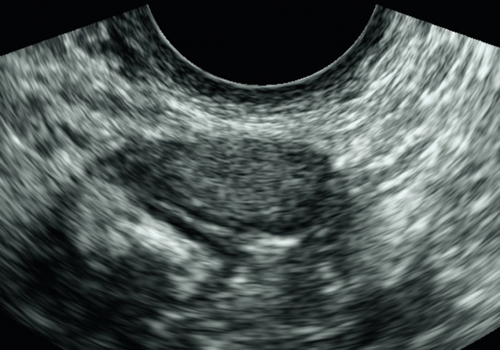Introduction (Chapter 1) - Ultrasound in Assisted Reproduction and ...