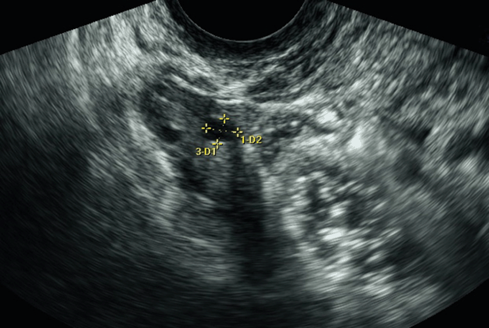 Physics and Instrumentation (Chapter 2) - Ultrasound in Assisted Reproduction and Early Pregnancy