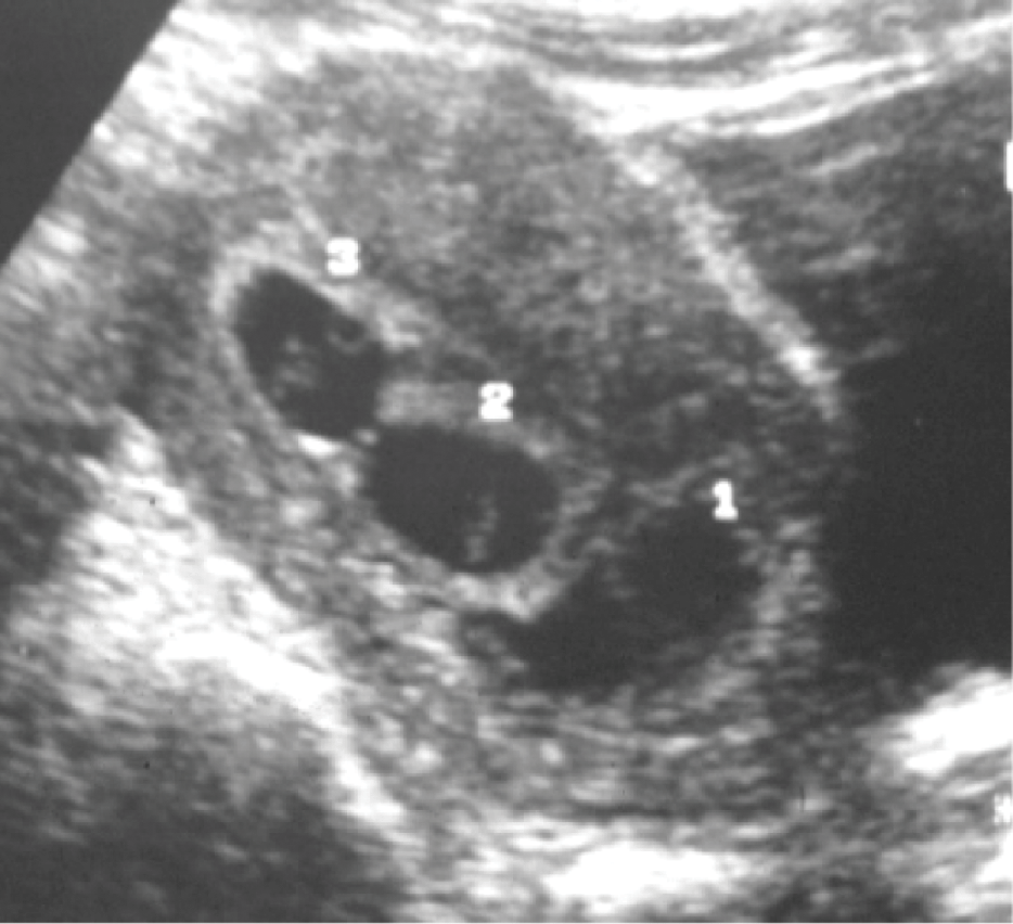 Triplets Ultrasound 4 Weeks