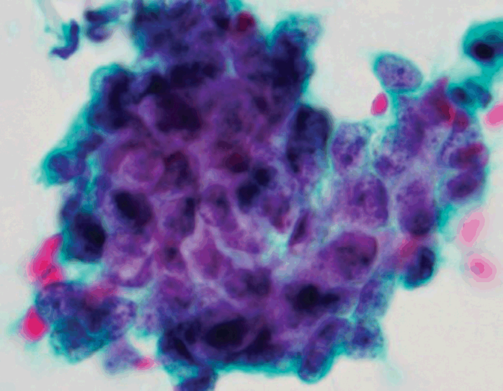 The Pap Smear (Chapter 1) - Differential Diagnosis in Cytopathology