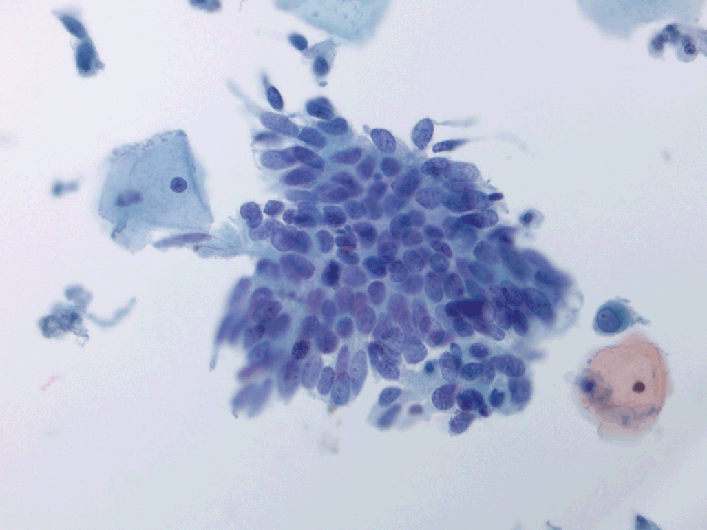 The Pap Smear (Chapter 1) - Differential Diagnosis in Cytopathology