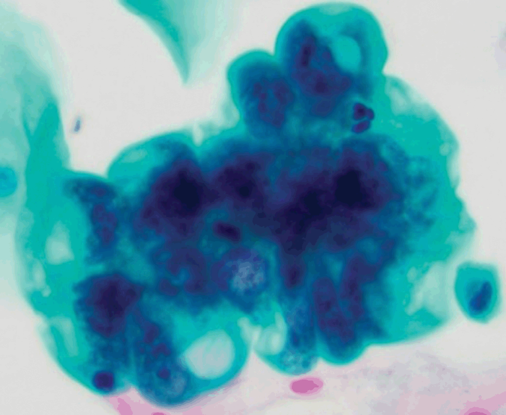 The Pap Smear (Chapter 1) - Differential Diagnosis in Cytopathology